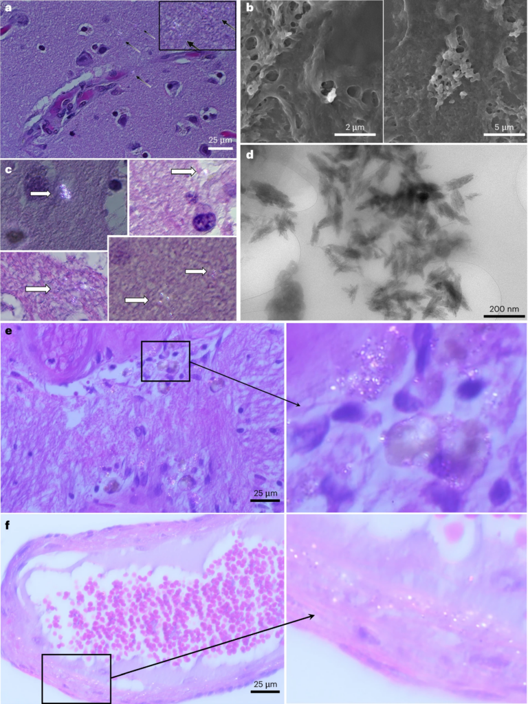 Detecting Microplastics in the Human Brain | Plastics Engineering